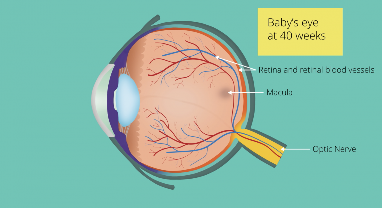 Retinopathy of Prematurity on Future Learn - ICEH